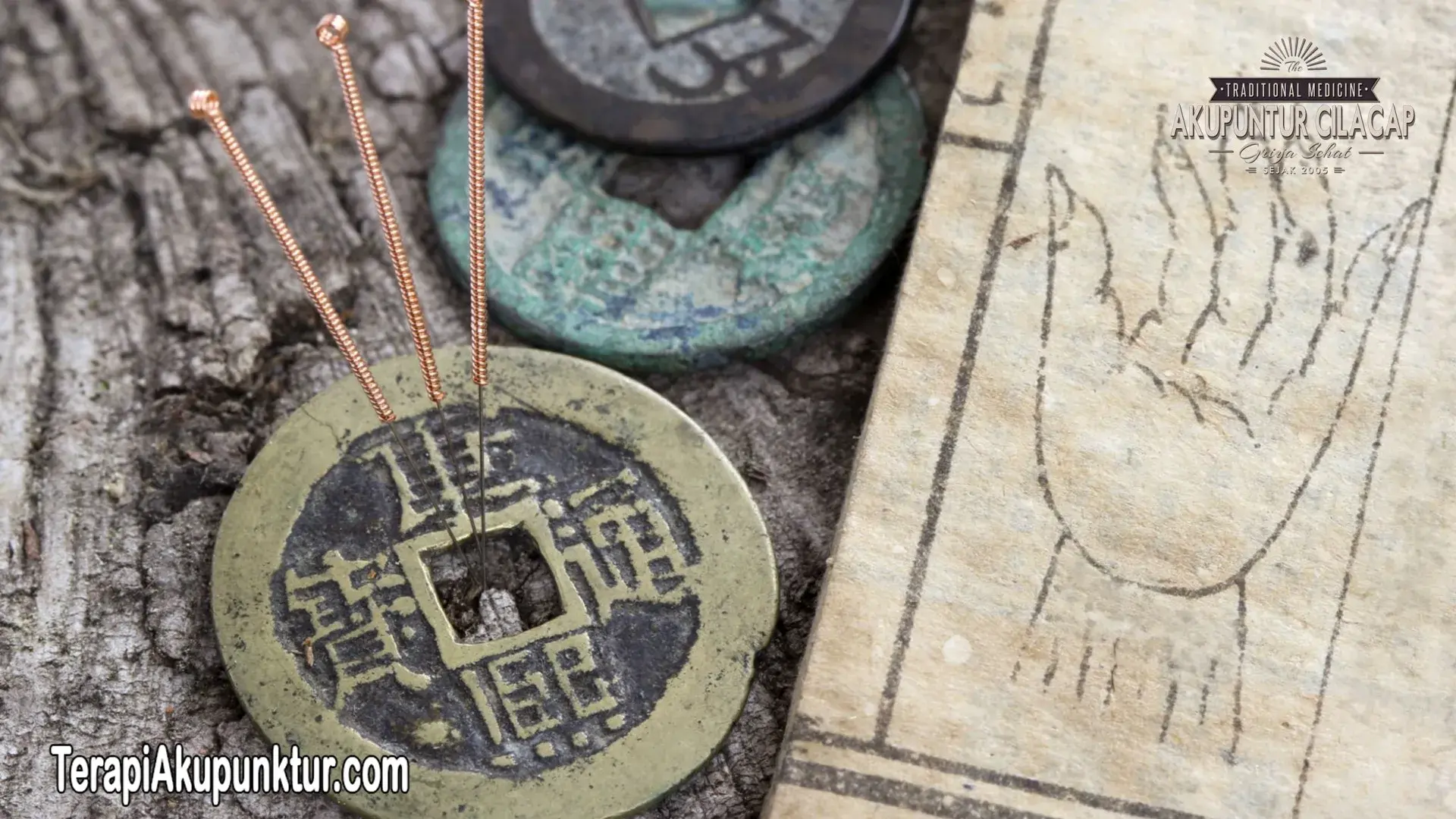 Terapi Akupunktur Untuk Gerd - Solusi Alami Atasi GERD No#1 ...